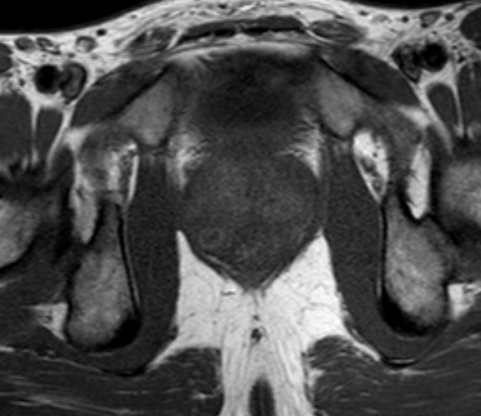 An unusual case of granulomatous prostatitis with caseification ...