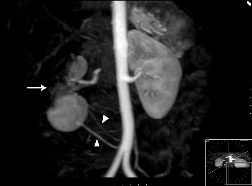 Renal artery dissection as an unusual cause of unilateral loin pain - BJUI