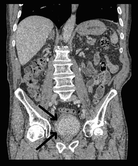 Acquired haemophilia in a patient with bladder cancer - BJUI