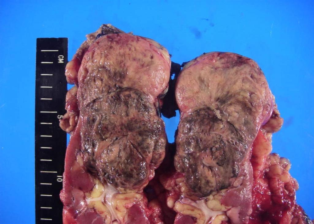 Eosinophilic Variant of Chromophobe Renal Cell Carcinoma with ...