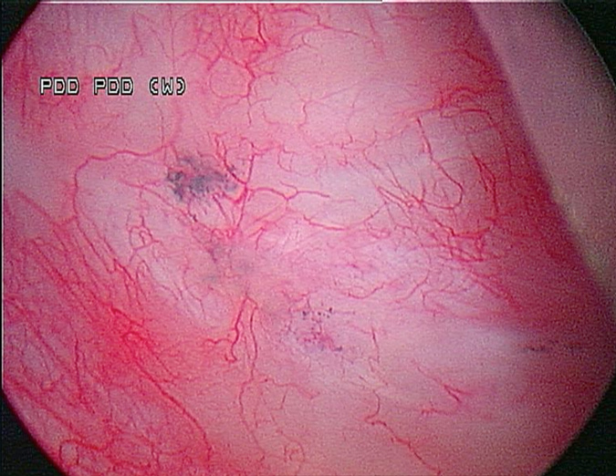 Diagnosis of a cryptic variant of urothelial carcinoma using blue-light ...