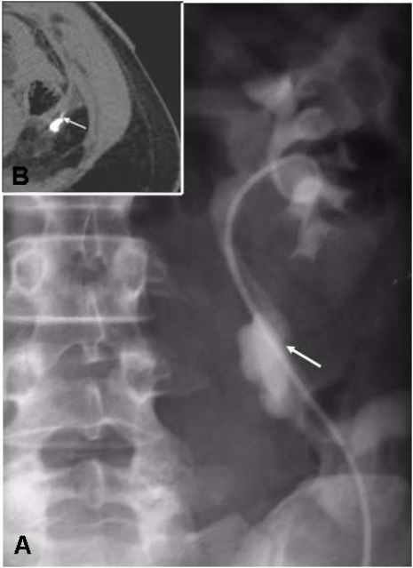 Complete ureteral avulsion: ileal ureteral substitution with an unusual ...