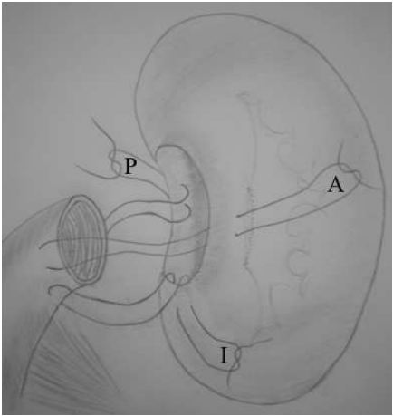 Complete ureteral avulsion: ileal ureteral substitution with an unusual ...